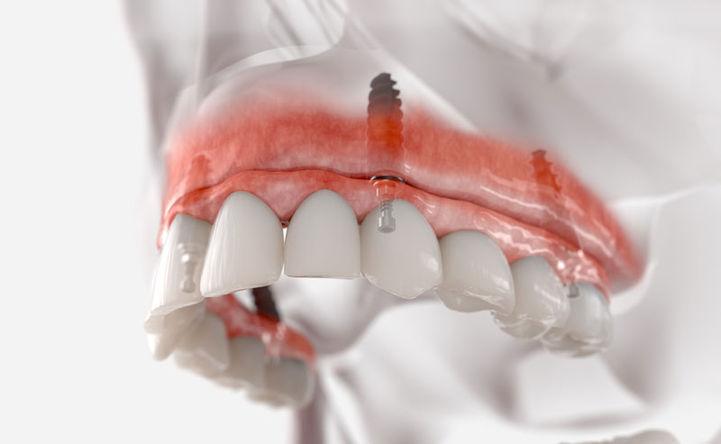 Navigating the Path to Smile Restoration: Unveiling the Secrets of ...
